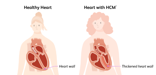 About Hypertrophic Cardiomyopathy (HCM)